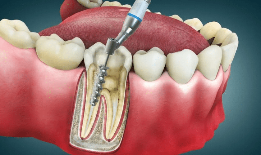 7 Signs You Need a Root Canal – Don’t Ignore These - Cosmofix Dental Care